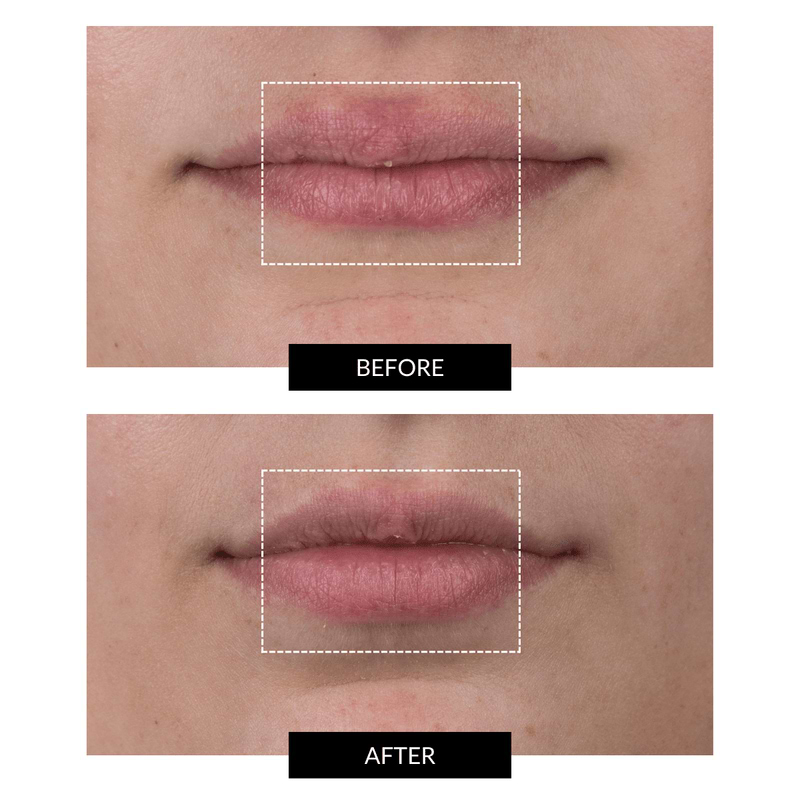 LED Lip Perfector | Lip Wrinkle & Volume Device LED Lip Perfector | Lip Wrinkle & Volume Device