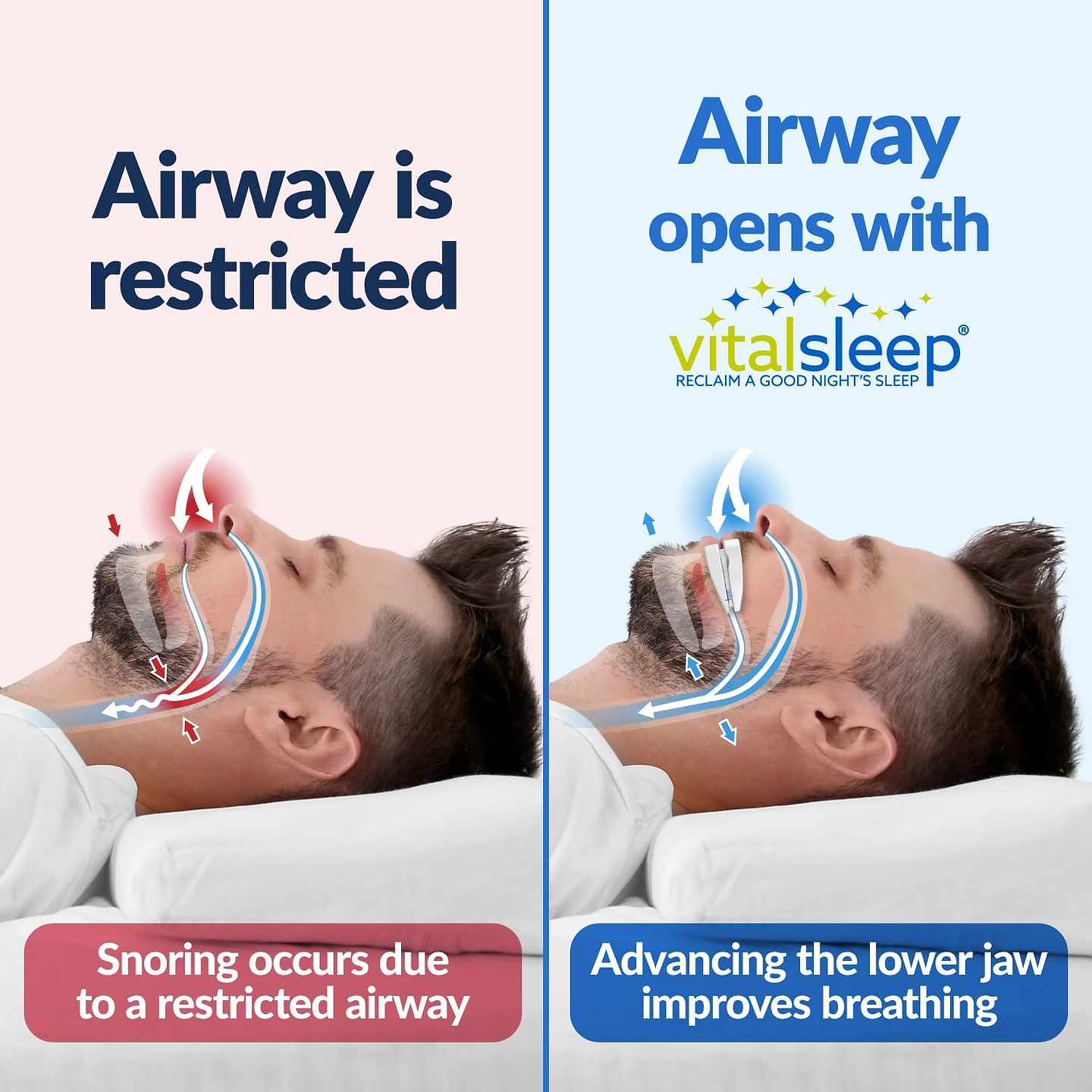 Snoring Mouthpiece - Best Anti Snoring Device VitalSleep